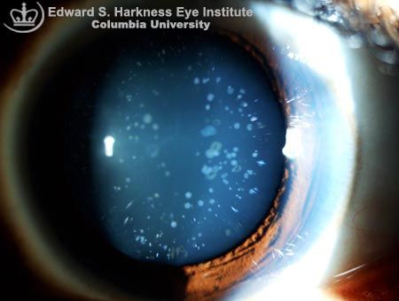 Ophthalmology Notes: Types of Cataract associated with Systemic Conditions