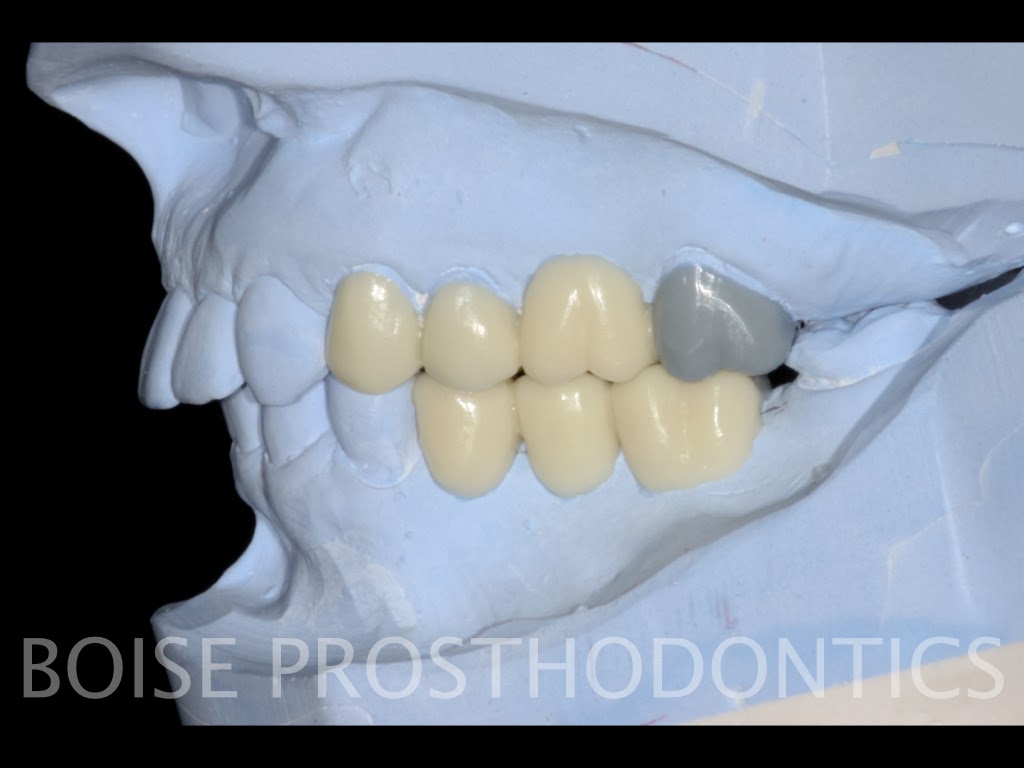 Boise Idaho Prosthodontics: Posterior Fixed Rehabilitation (limited ...