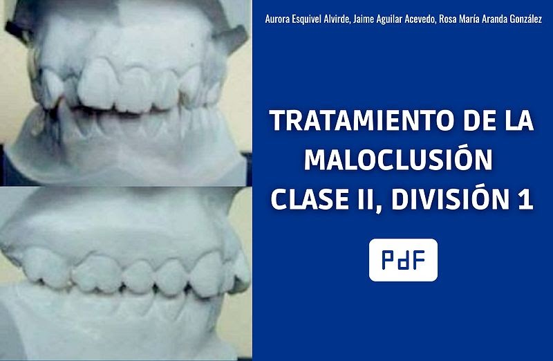 PDF: Tratamiento de la Maloclusión Clase II, División 1 - Ovi Dental