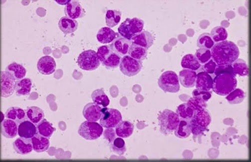 Atlas de hematologia: Leucemia Mielocitica Crónica