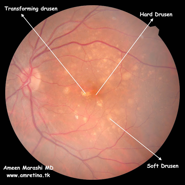Drusen in non-neovascular ARMD and subtypes