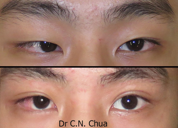 Eyelid Surgery by Prof Dr CN CHUA 蔡鐘能: Doc, Can You Straighten My Eye? II