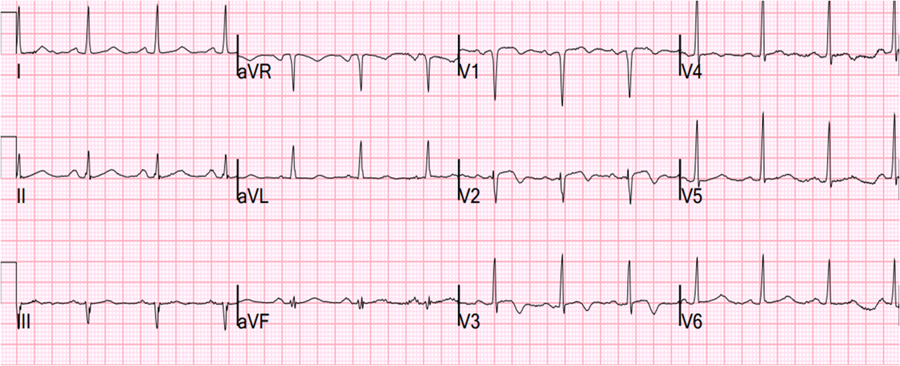 Dr. Smith's ECG Blog: Septal STEMI with lateral ST depression, then has ...