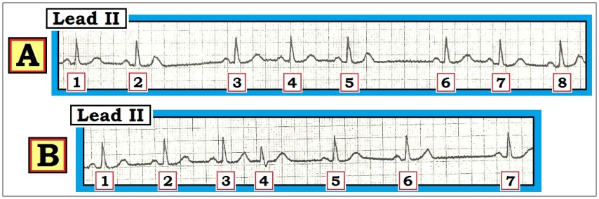 ECG Interpretation: ECG Interpretation Review #66 (2nd Degree AV Block ...