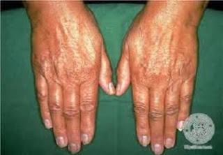 Health And Beauty Tips: Symptoms of Addison's disease