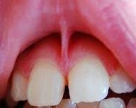 Frenectomy