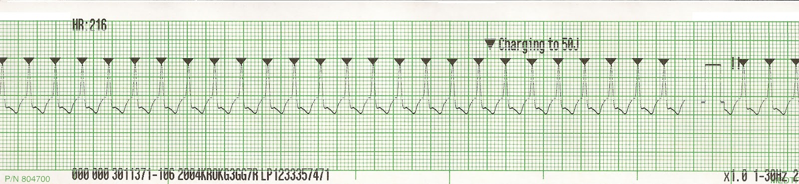 Pediatric SVT