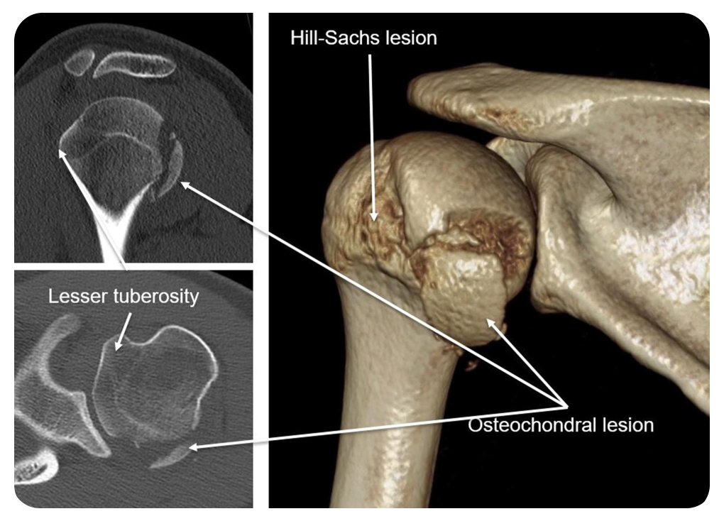 Revisiones_bibliográficas TyO_Web: Fractura por rotura osteocondral de ...