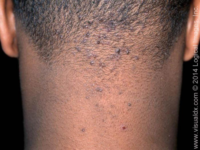 Acné Keloidalis Nuchae Antes Y Después