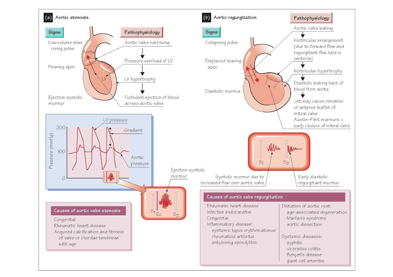 Diseases Of The Aortic Valve - pediagenosis