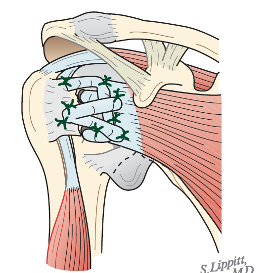 Shoulder Arthritis / Rotator Cuff Tears: causes of shoulder pain: The ...