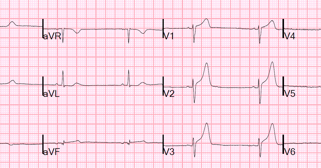 Dr. Smith's ECG Blog: Patient presentation is important, and so is R ...