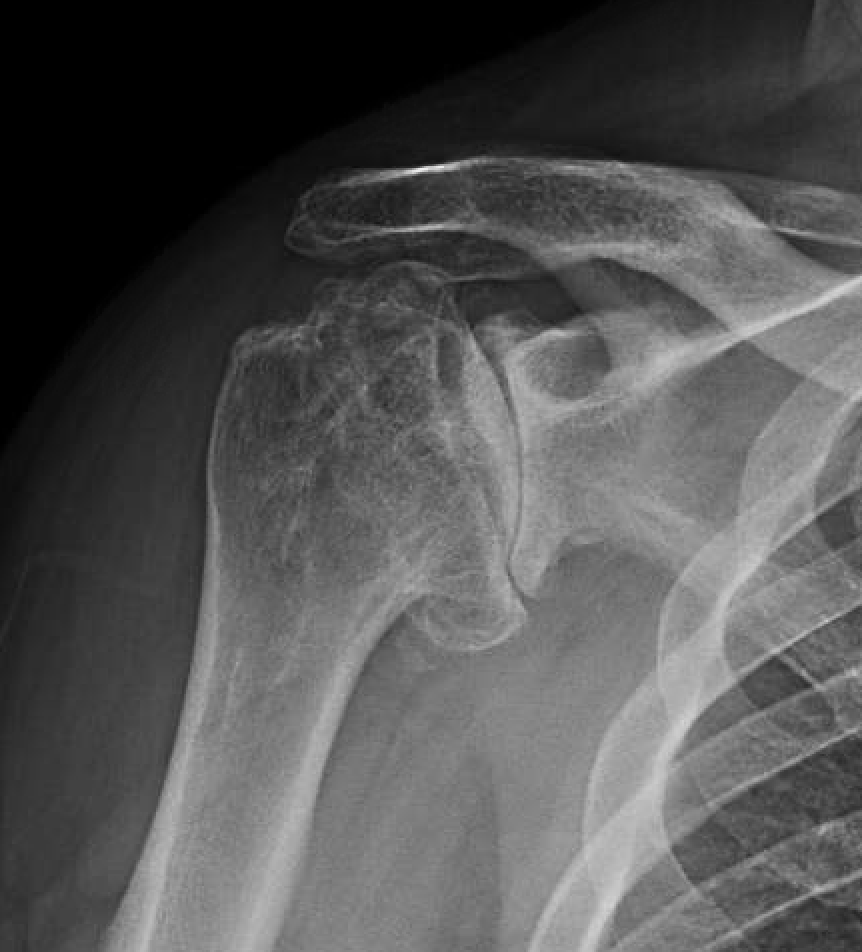 UW Shoulder and Elbow Academy: Ream and run for the retroverted glenoid ...