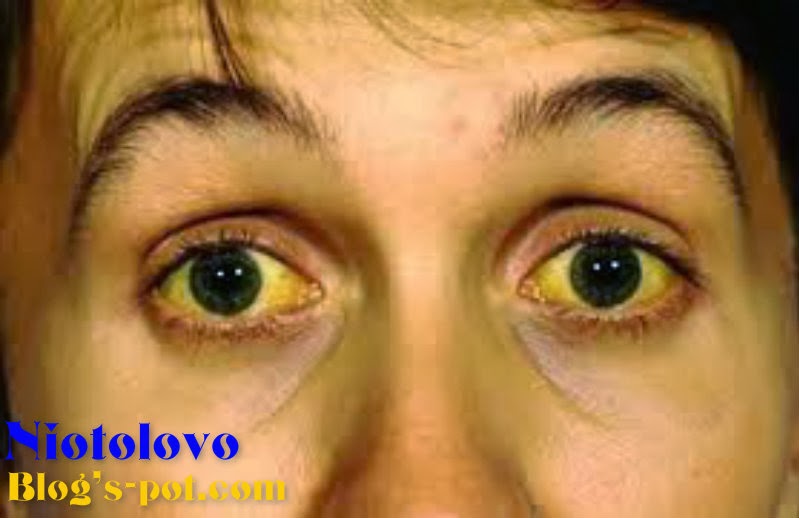 Seputar Penyakit Jaundice atau Sakit Kuning - Niotolovo