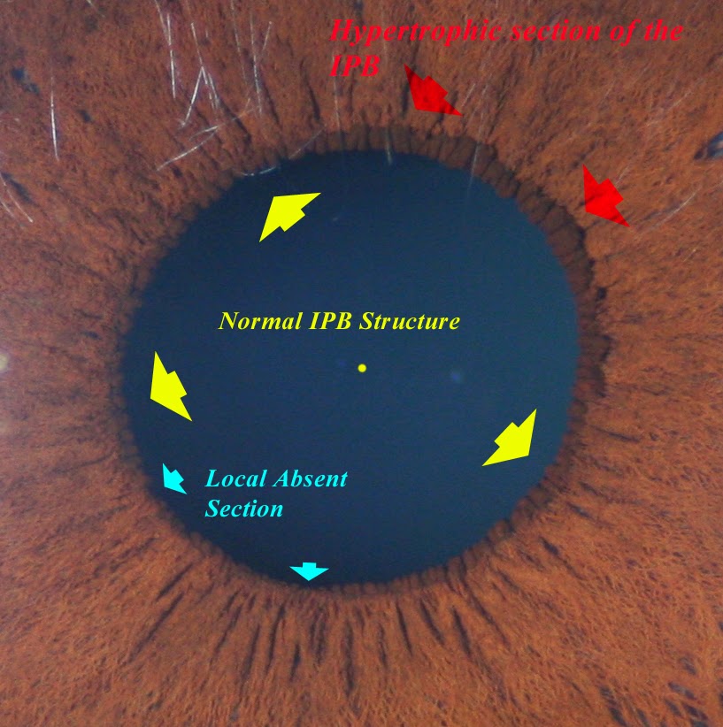 Modern & Multidimensional Iridology: Mixed Inner Pupillary Border ...