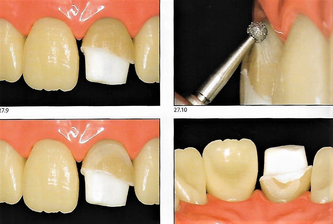 Anterior Crown Preparation | Dental Esthetics
