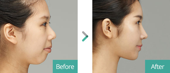 Plastic Surgery in Korea : Short-chin complex can be solved through ...