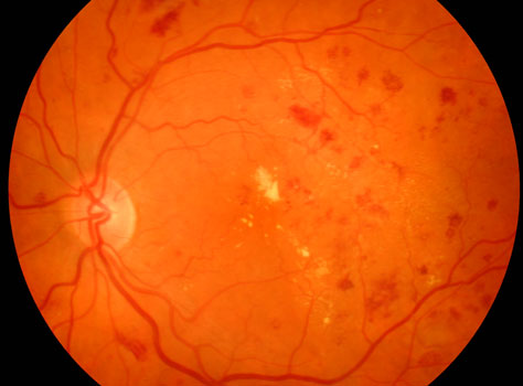 diabetic retinopathy risk factors and its stages