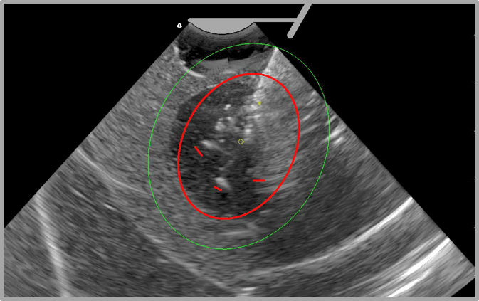 Ob/Gyn Updated : Minimally invasive transcervical radiofrequency ...