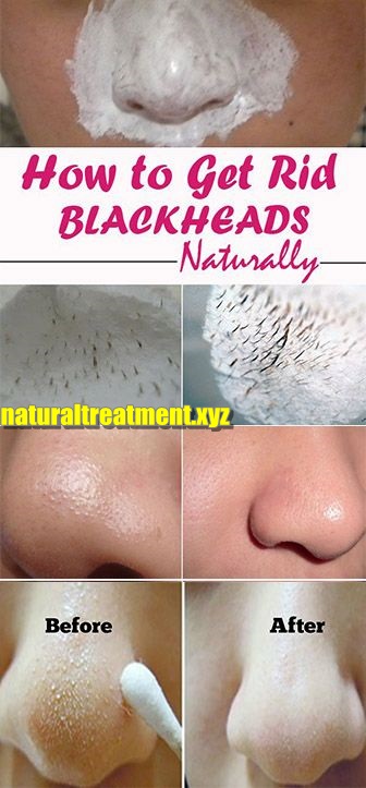 How To Get Rid Of Blackheads Naturally Home Remedies