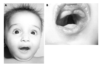 THYROID PART 4 HYPOTHYROIDISM