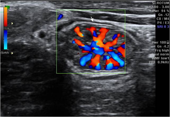 ‘DESCENDING COLONIC POLYP’- An ultrasound diagnosis - Sumer's Radiology ...