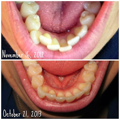 Sunshine!: Invisalign Update