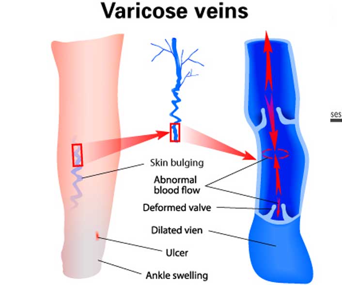 Prostate Enlargment Treatment without Surgery: Treatment Options for ...