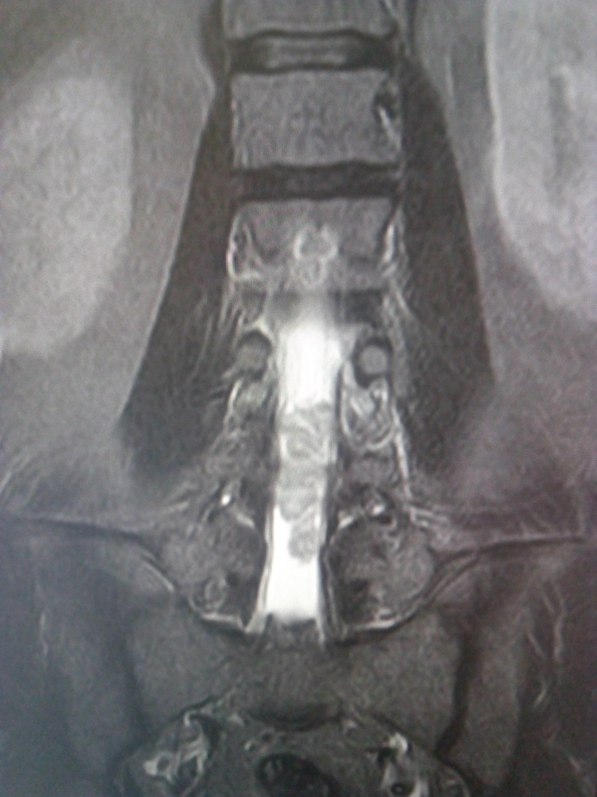 Cauda equina mass: An Approach - Sumer's Radiology Blog