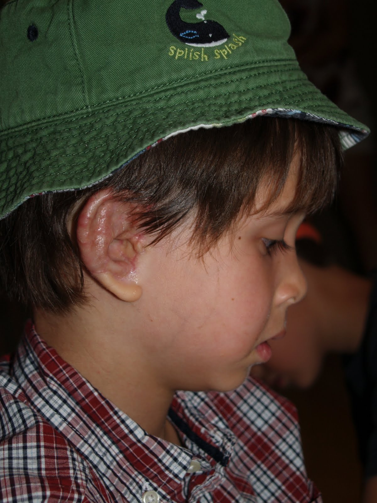 Microtia and Aural Atresia - Our Experience: Six Weeks Post Microtia Repair