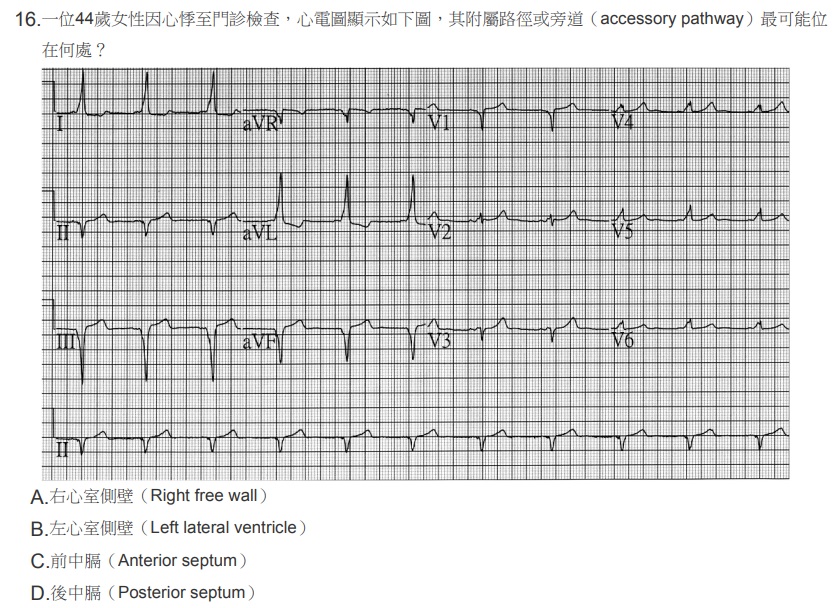 WPW syndrome：副傳導路徑 (Accessory pathway)如何定位？