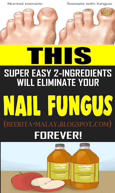 This Super Easy 2 Ingredient Recipe Will Eliminate Your Nail Fungus