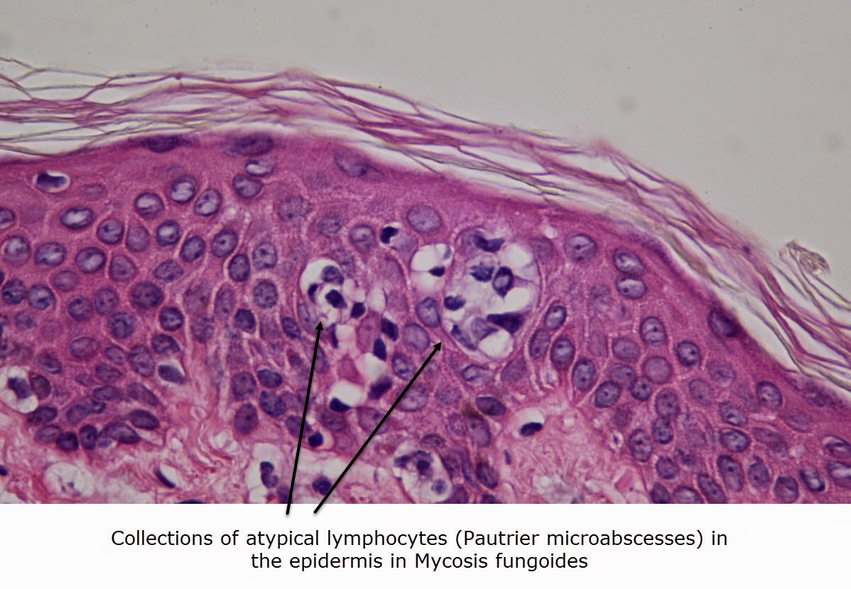 Dermatopathology Made Simple - Inflammatory: Psoriasiform Reaction Pattern