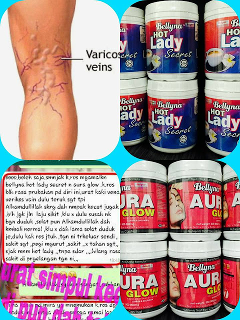 BELLYNA: TESTIMONI BELLYNA COFFEE : MASALAH URAT TIMBUL / SIMPUL ...