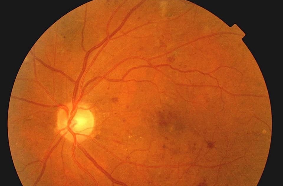 Diabetic macular edema with ischemic changes associated with very ...