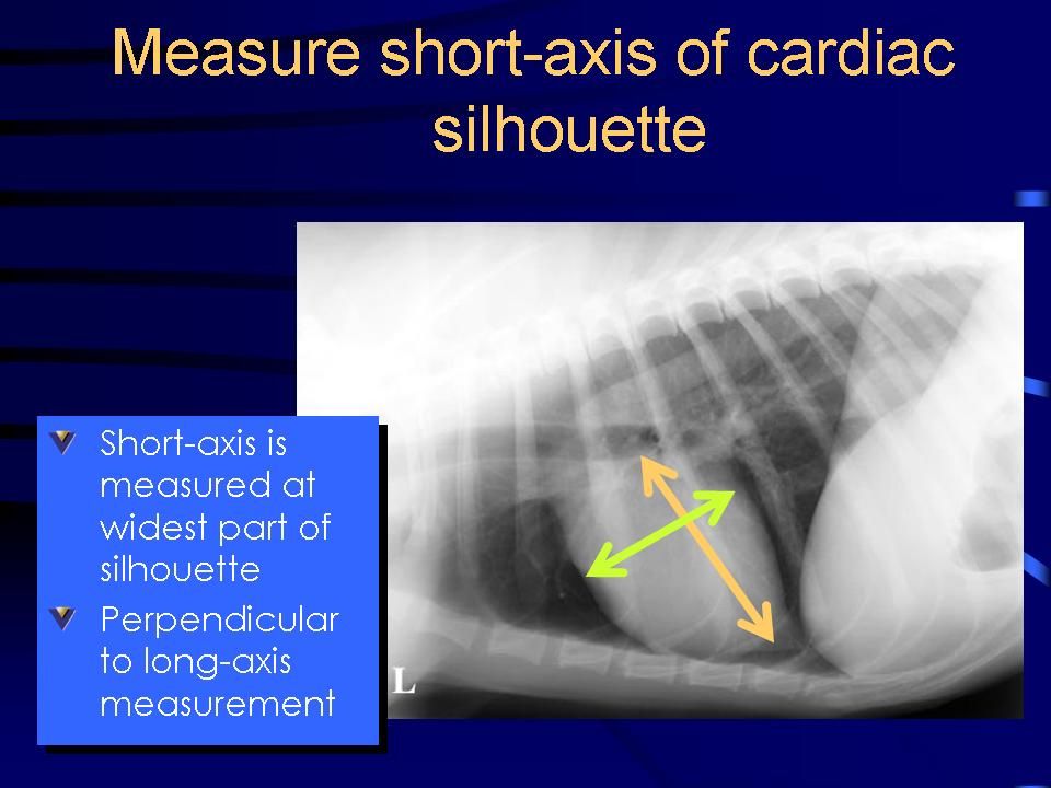 Imacardio: El Vertebral Heart Score (Índice cardiaco vertebral)