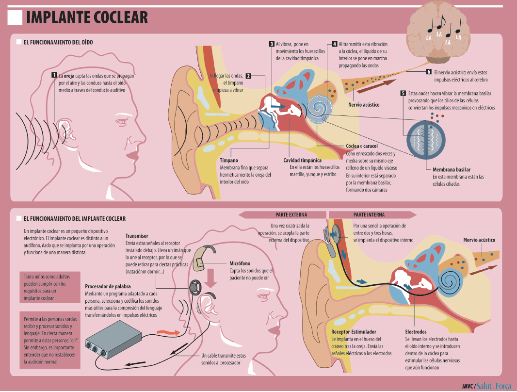 MundOtorrino. La ORL al día.: El implante coclear. ¿Funciona?