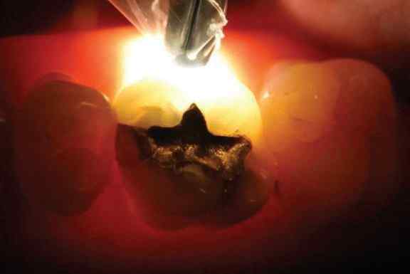 Cracked Tooth Syndrome: Detailed Explanation!!