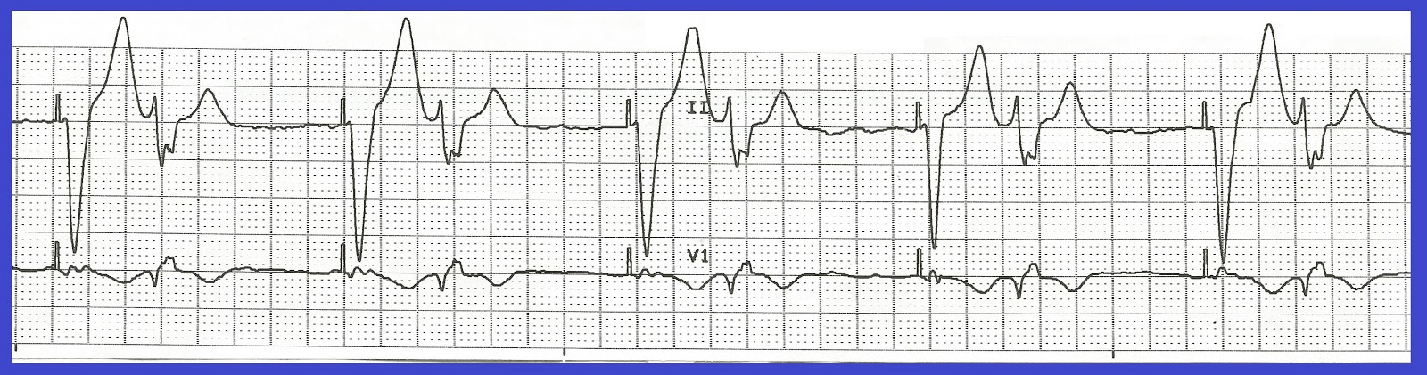 Practice EKG Rhythm Strips 185