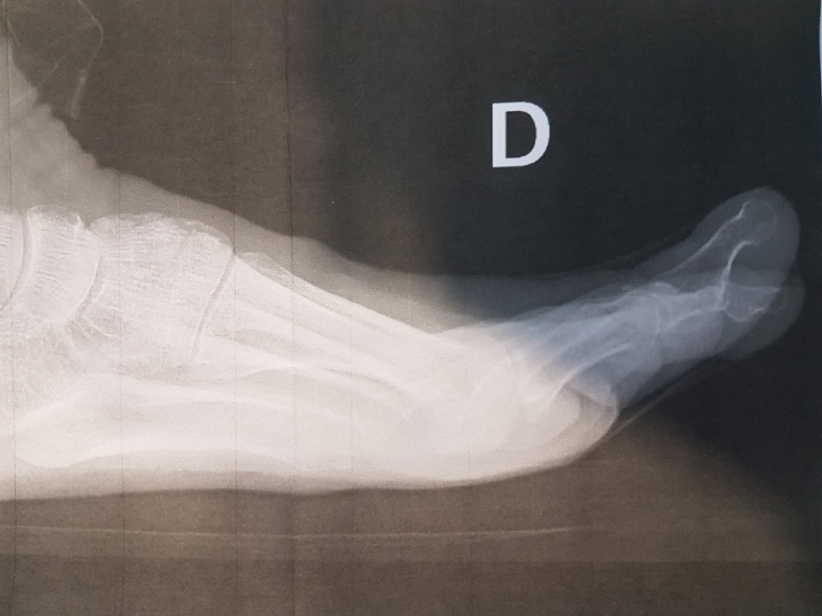 Podo Basas al Día: Alargamiento de gastrocnemio. Papilomas con ...