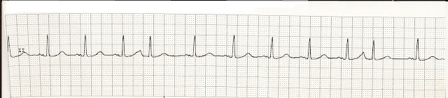 EKG Rhythm Strip Quiz 17