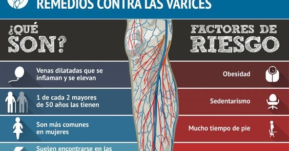 ¿Qué son las varices y cómo se pueden combatir?]