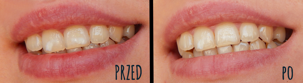 Wybielanie zębów w domu – Pearl Drops Pure Bleaching White - Jedno ...