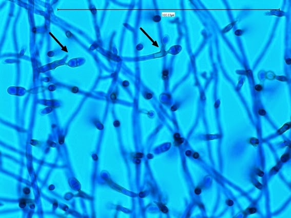 Fun With Microbiology (What's Buggin' You?): Ochroconis species