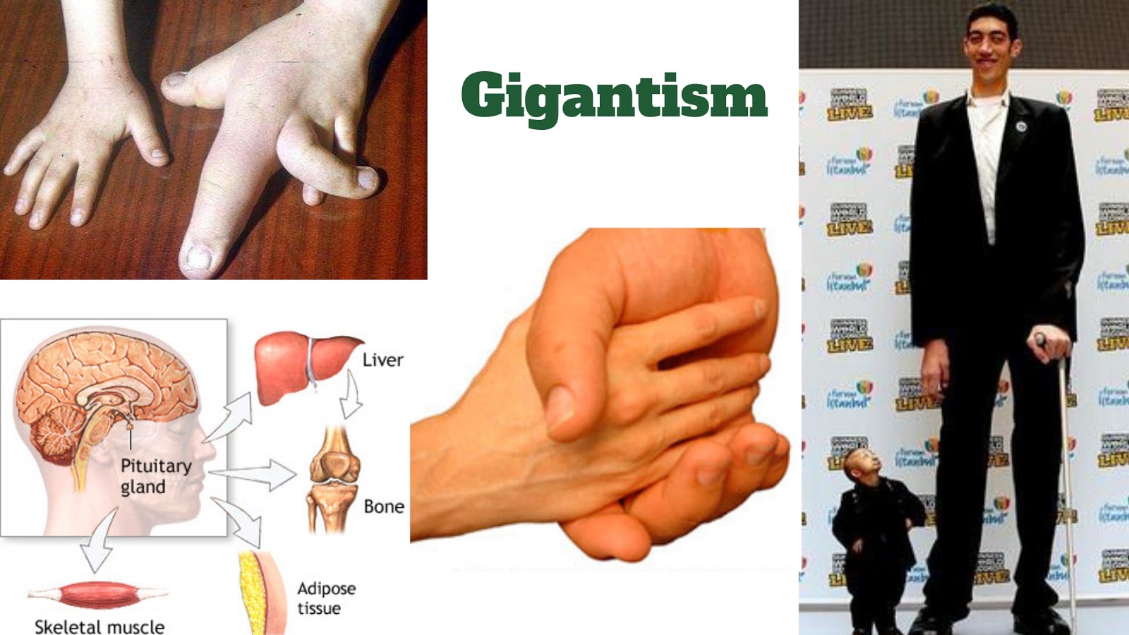 Rare Diseases of Endocrine System