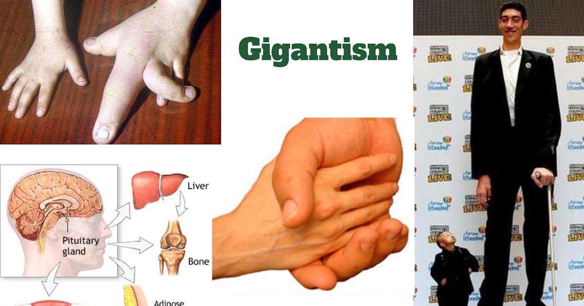 Rare Diseases of Endocrine System