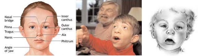 fetal alcohol syndrome pictures