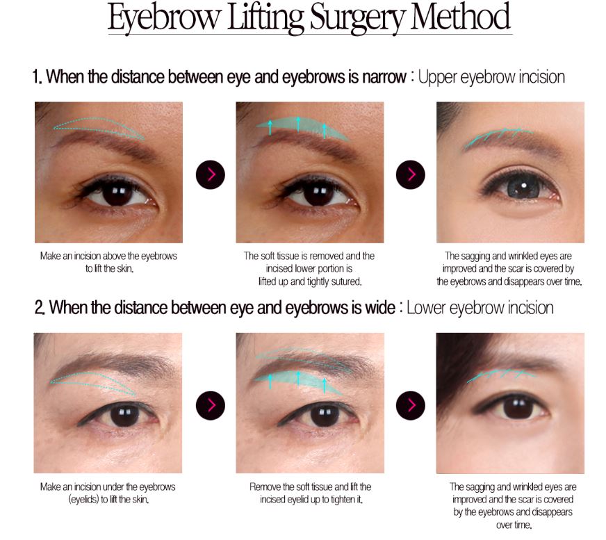 The difference between Upper blepharoplasty and Eyebrow lifts