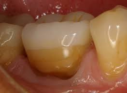 Endocrown adhesive restorative dentistry new crown