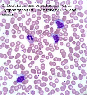 Case study (15)- Infectious mononucleosis with lymphocytosis